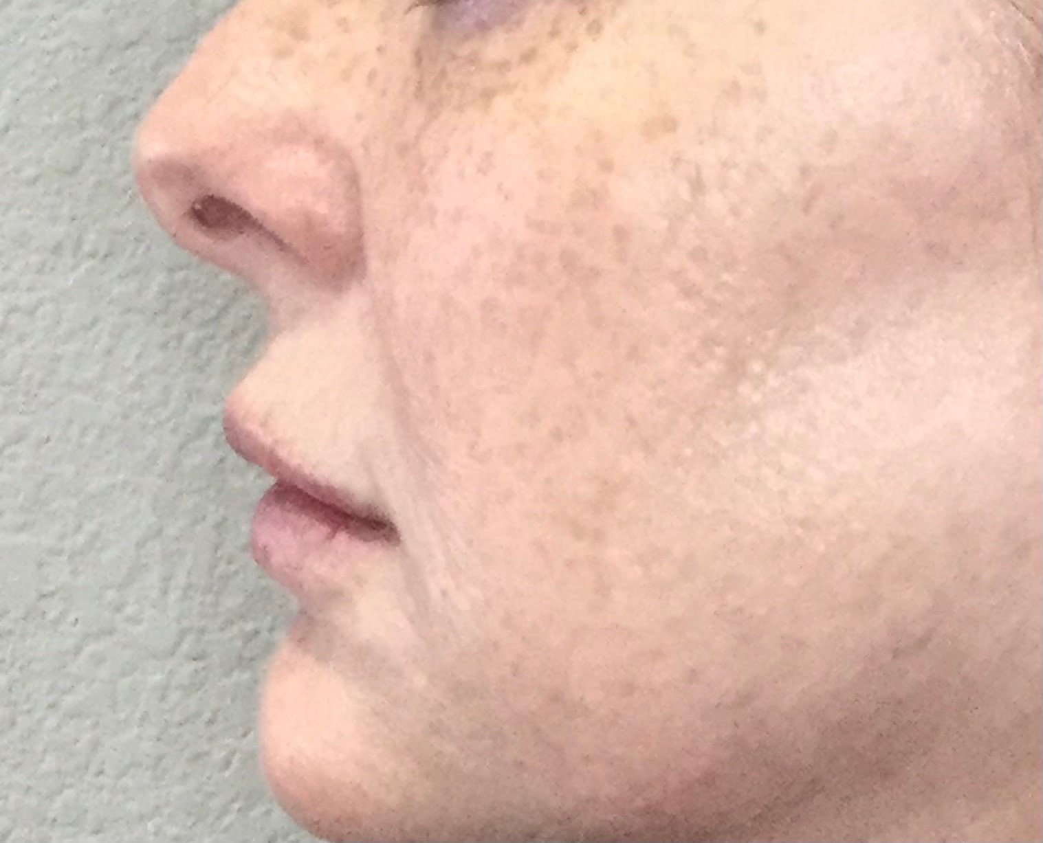 Types of Hyperpigmentation on the Face