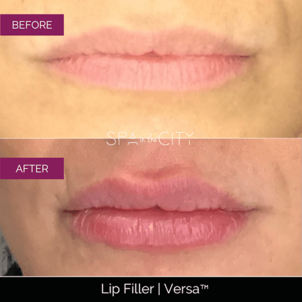 Versa Filler | Versa Filler Benefits | Versa Filler Options | Versa ...