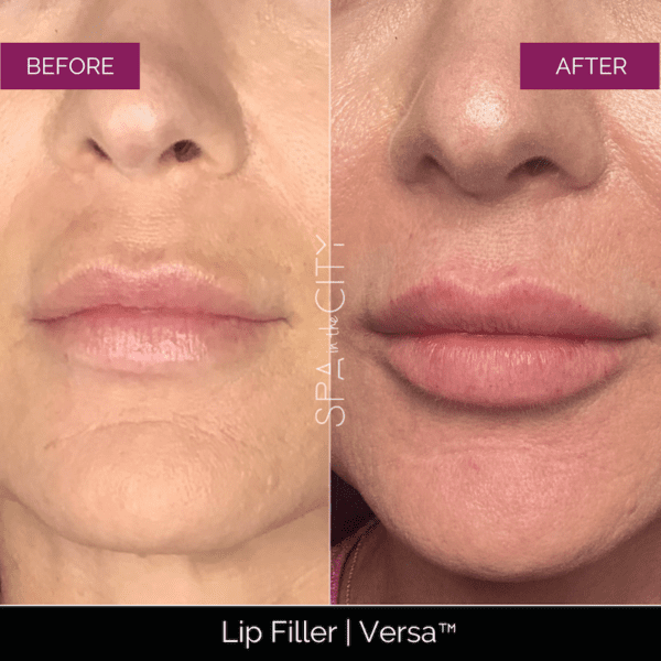 Versa Filler | Versa Filler Benefits | Versa Filler Options | Versa ...